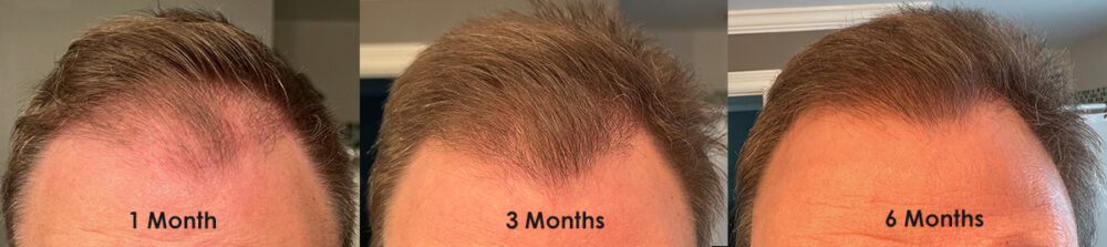 6 Month Hair Transplant Transition - Hair Restoration Center of CT ...