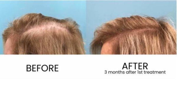 Exosome Hair Loss Therapy | Hartford, CT