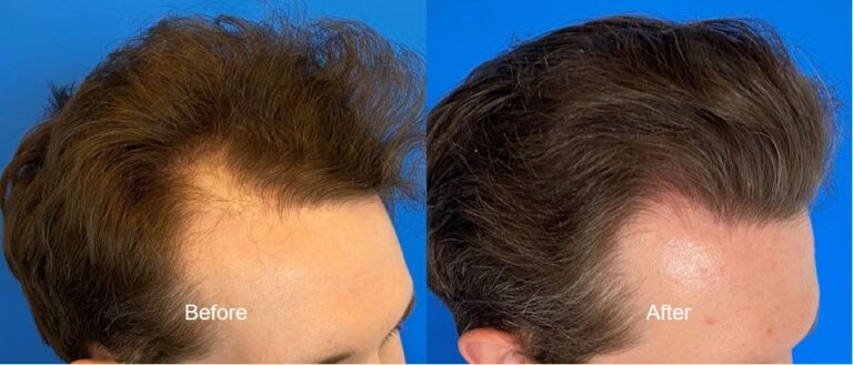 Hairline Restoration with FUT Donor Strip Harvest - Hair Restoration ...